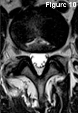 Read Your MRI Basic Education from a World-Renowned Spine Expert ...