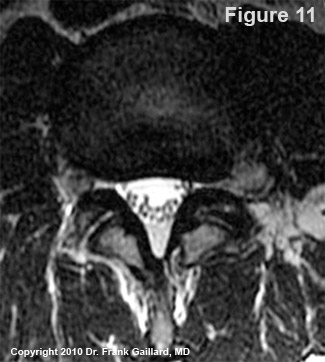 Read Your MRI Basic Education from a World-Renowned Spine Expert ...