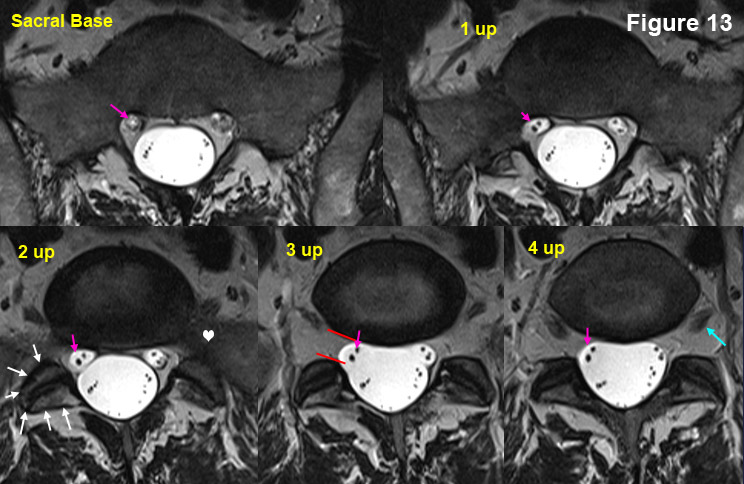 Thecal Sac Mri