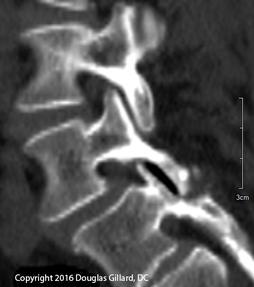 Spondylolisthesis, & Back Pain Advice by a World-Renowned Spine Expert ...