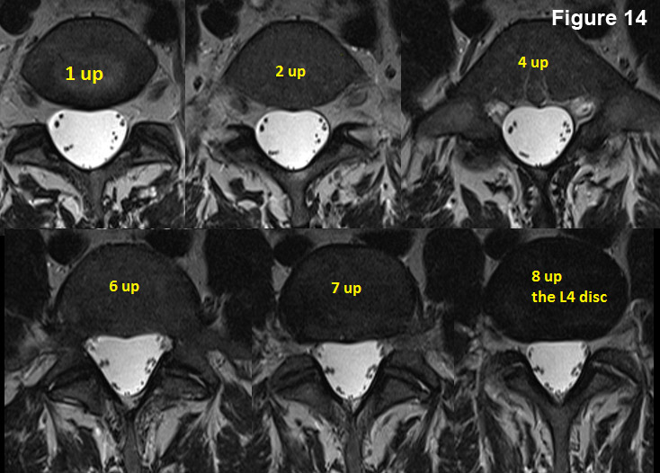 Read Your MRI Basic Education from a World-Renowned Spine Expert ...
